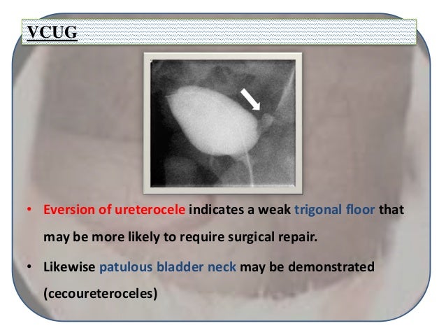 Ureterocele,