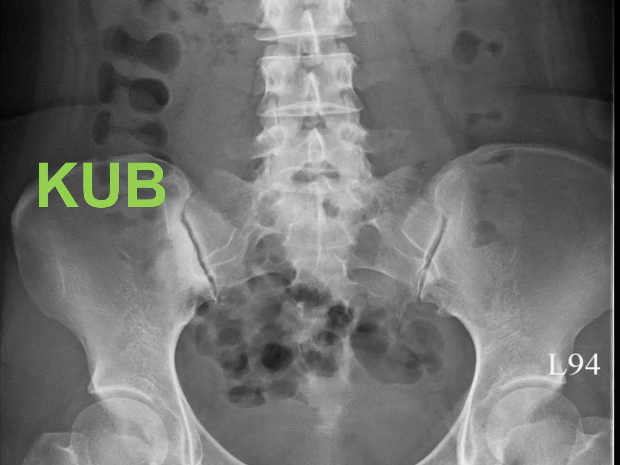 Ureterocele and Duplicated Collecting System | PPTX