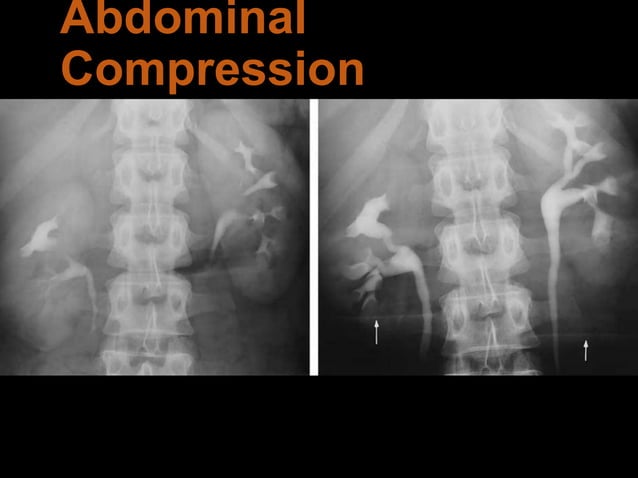 Ureterocele and Duplicated Collecting System | PPTX