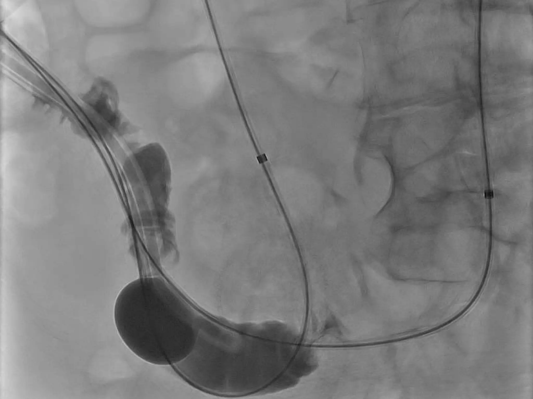 How to treat an ureteroenteric obstruction in a Bricker deviation ...