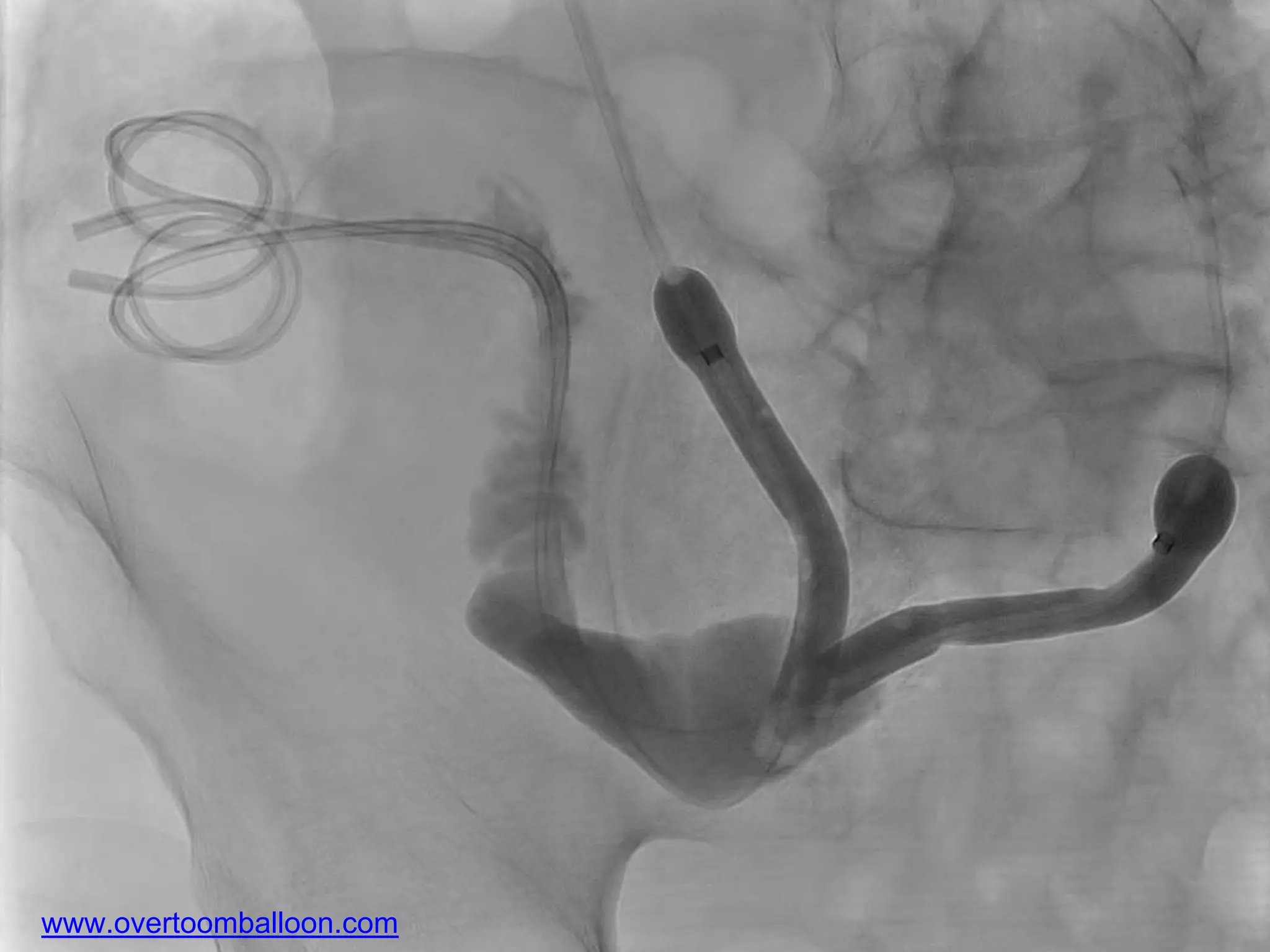 How to treat an ureteroenteric obstruction in a Bricker deviation ...