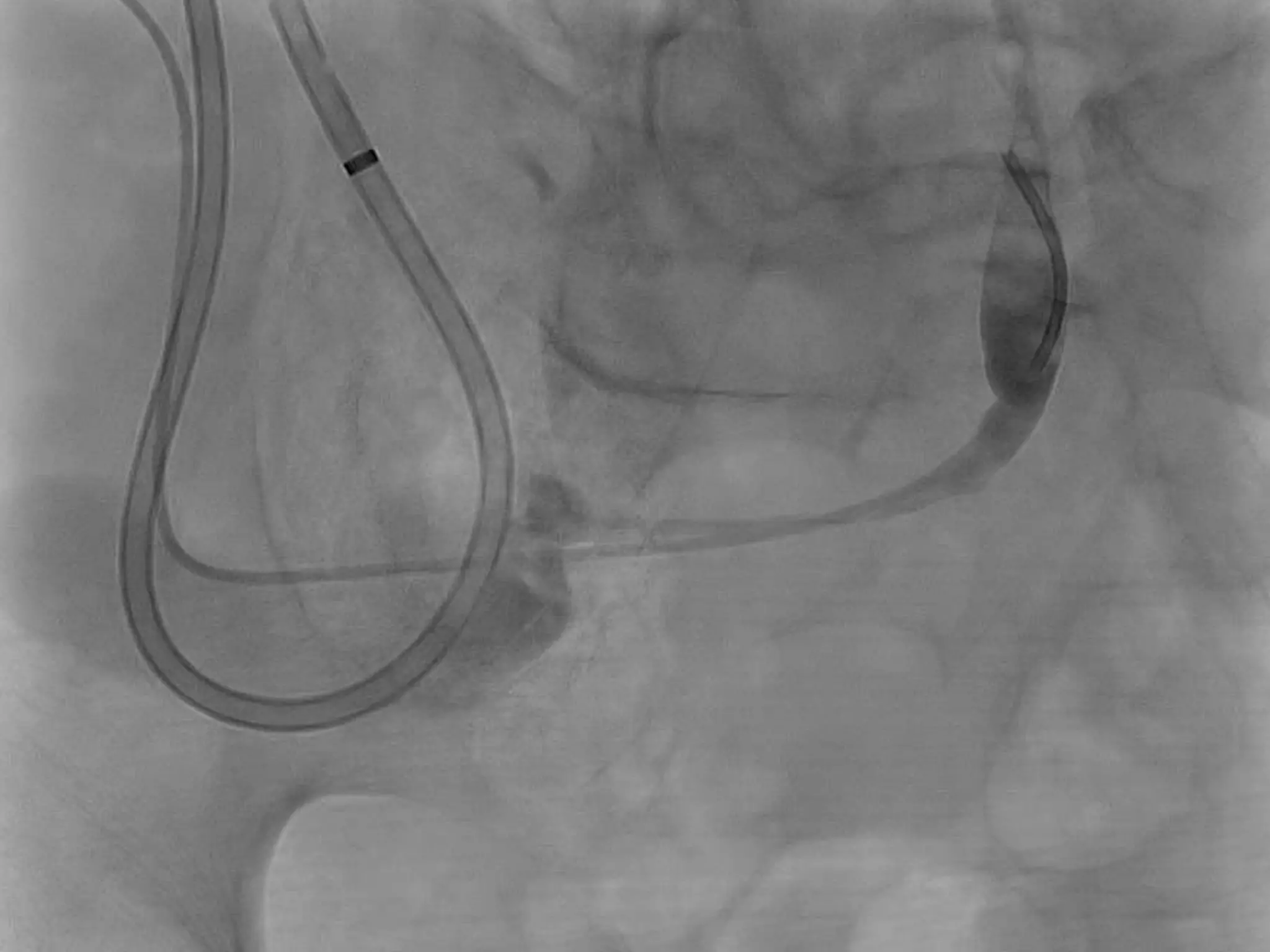 How to treat an ureteroenteric obstruction in a Bricker deviation ...