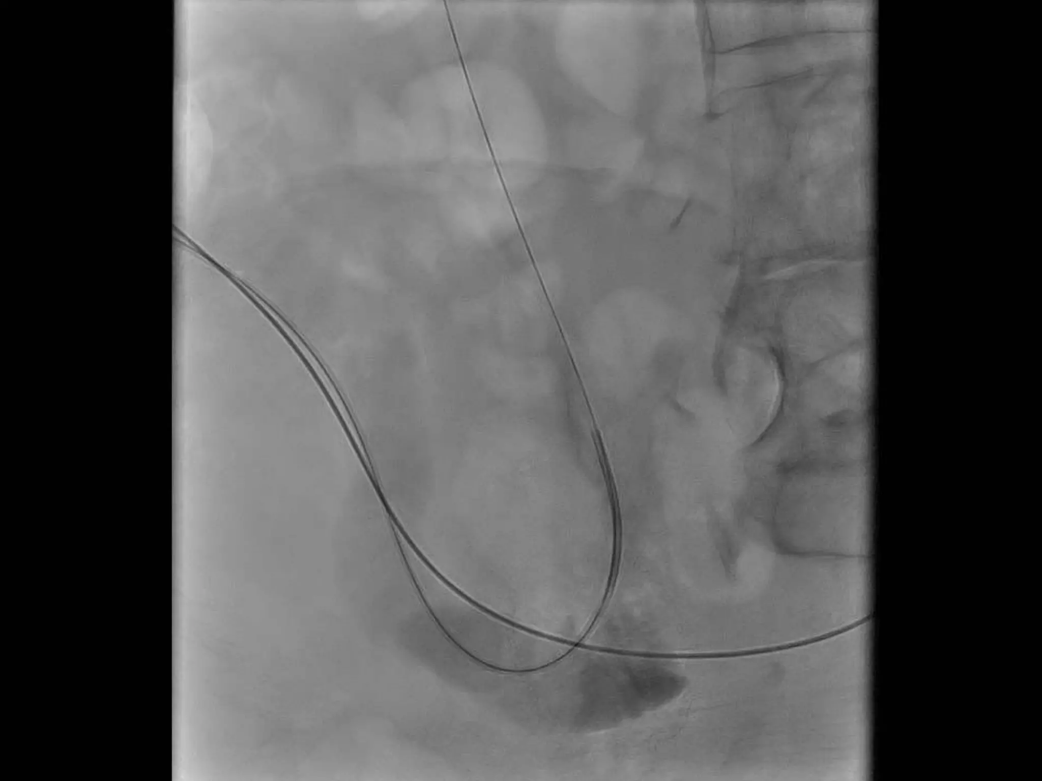 How to treat an ureteroenteric obstruction in a Bricker deviation ...