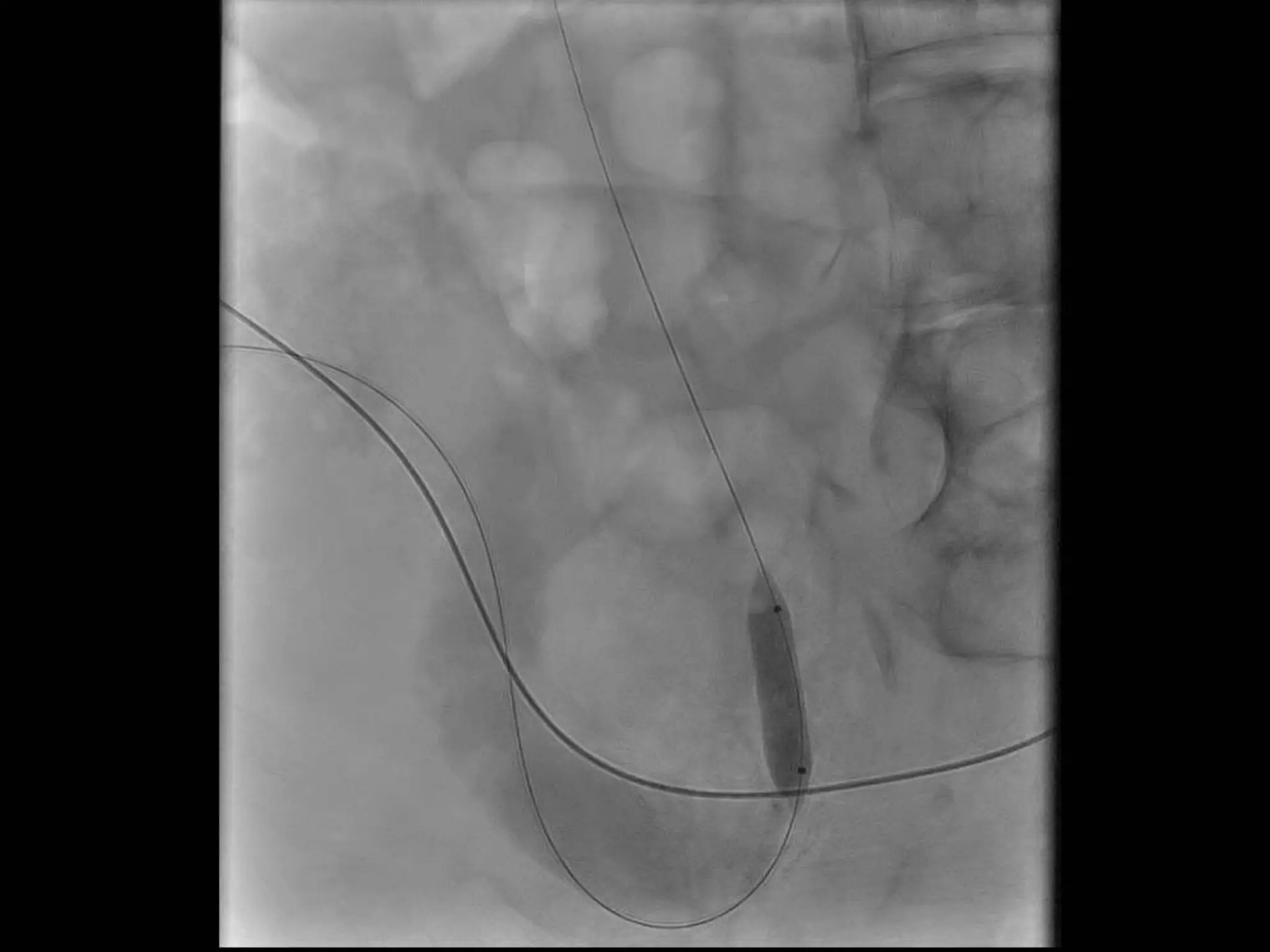 How to treat an ureteroenteric obstruction in a Bricker deviation ...