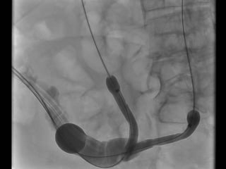 How to treat an ureteroenteric obstruction in a Bricker deviation ...