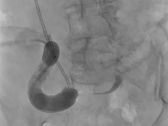 How to treat an ureteroenteric obstruction in a Bricker deviation ...