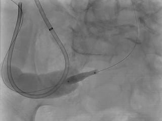 How to treat an ureteroenteric obstruction in a Bricker deviation ...