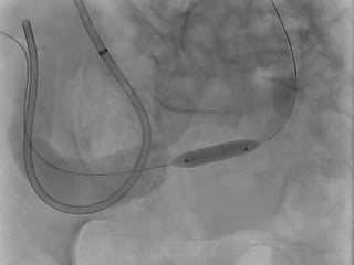 How to treat an ureteroenteric obstruction in a Bricker deviation ...