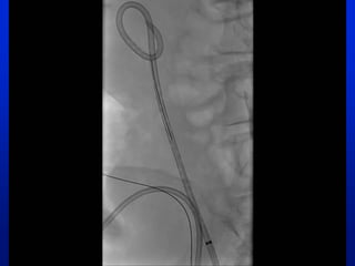 How to treat an ureteroenteric obstruction in a Bricker deviation ...