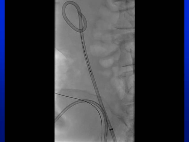 How to treat an ureteroenteric obstruction in a Bricker deviation ...