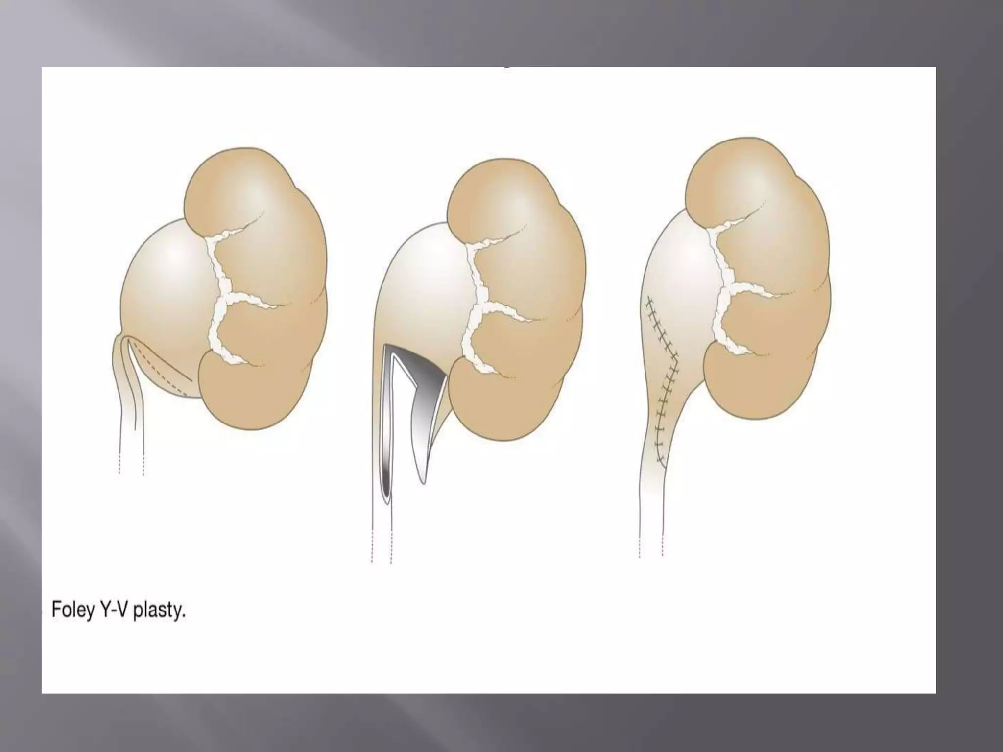 Ureteropelvic junction obstruction in children | PPTX
