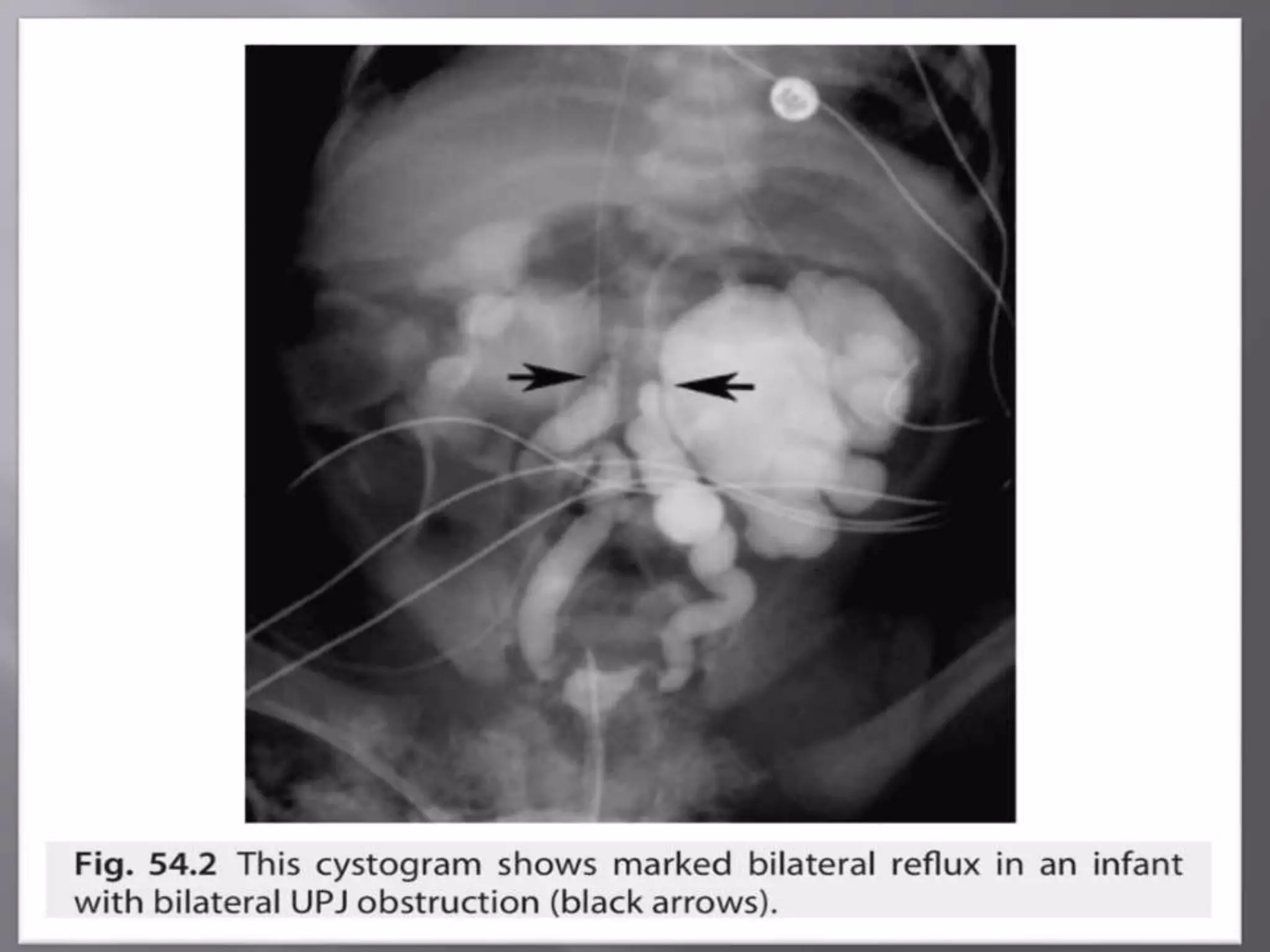 Ureteropelvic junction obstruction in children | PPTX