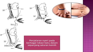 Batu saluran kemih tindakan ureteroskopi | PPTX