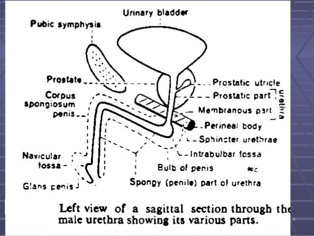 Uretheral stricture
