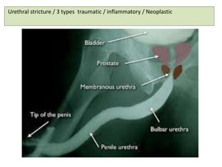 Urethra lesions | PPT