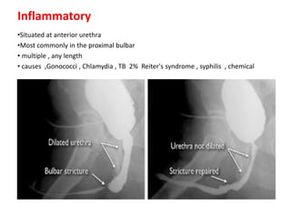 Urethra lesions | PPT