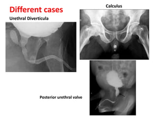 Urethra lesions | PPT