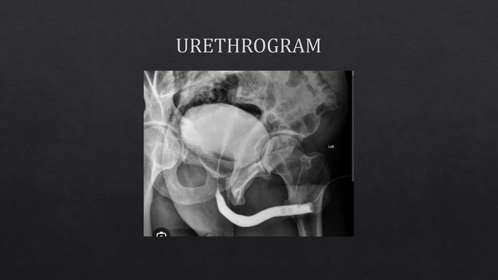 Urethral-Stricture-By-Dr-Abdul-Rehman.pptx