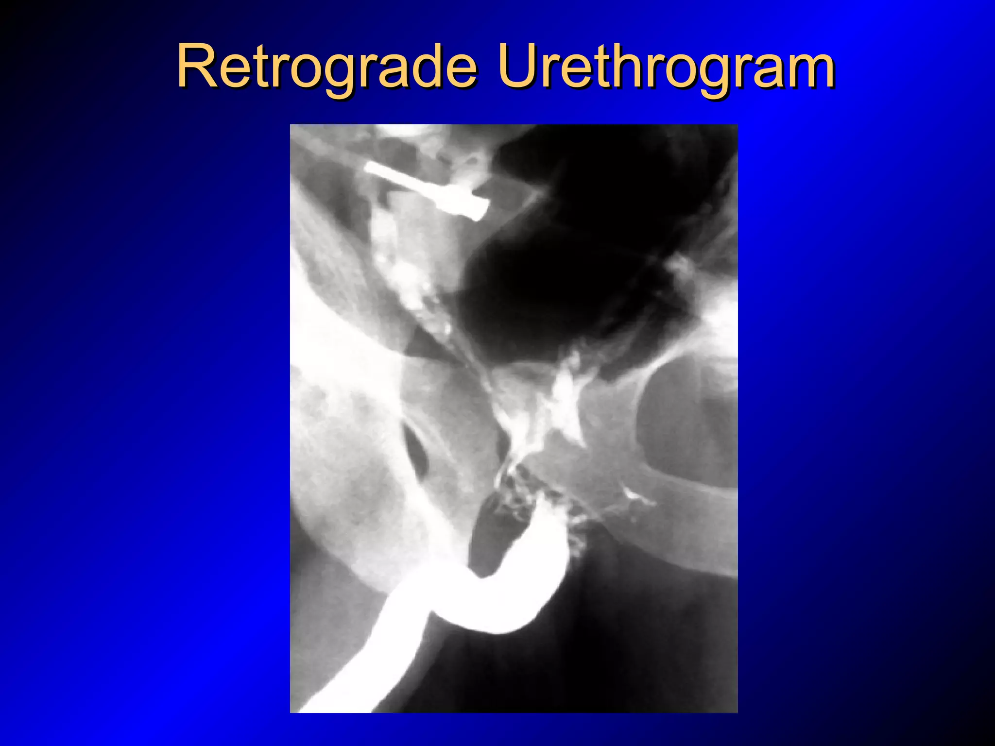 Urethral catheterization | PPT