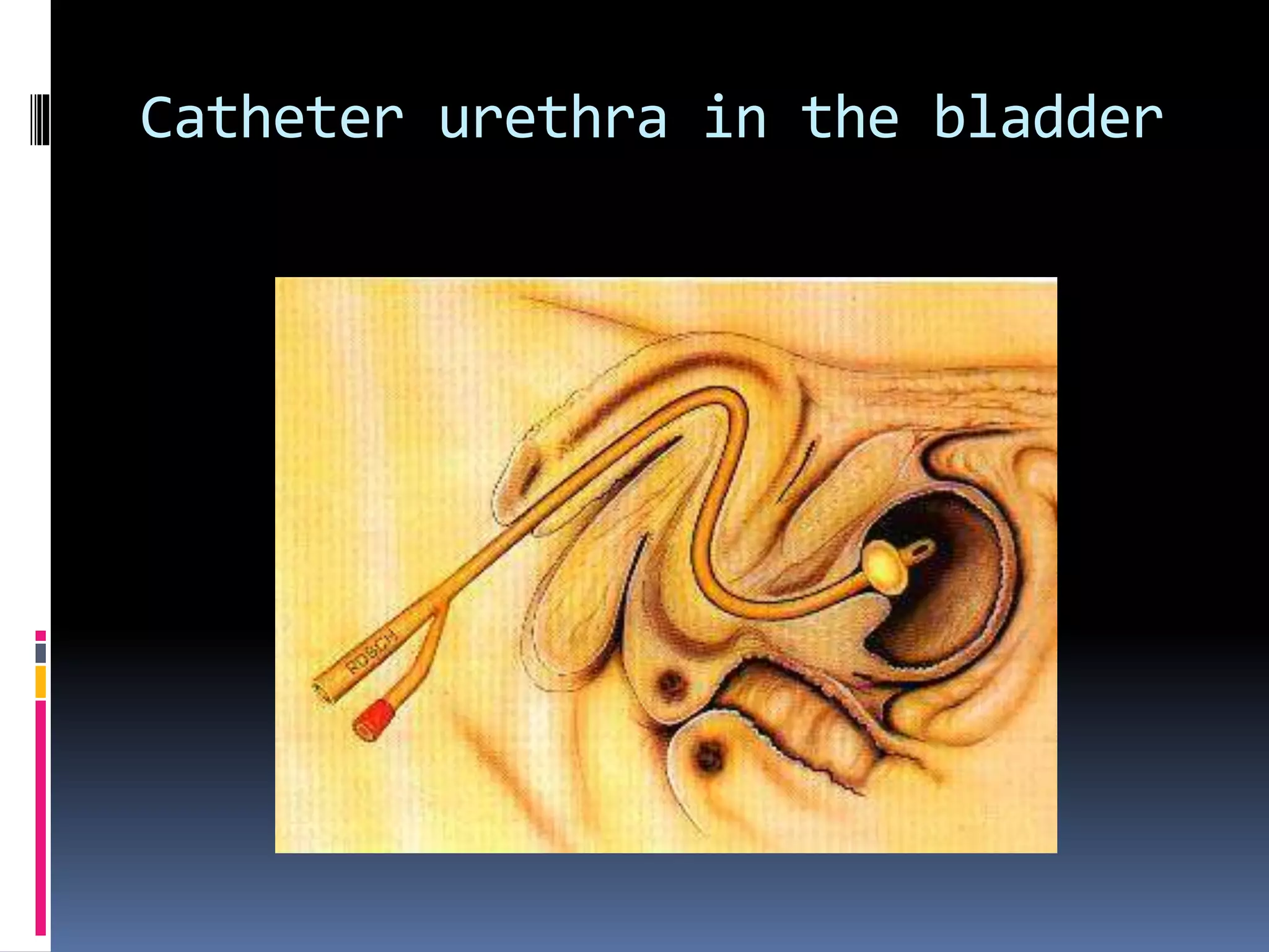 Urethral catheterization | PPTX