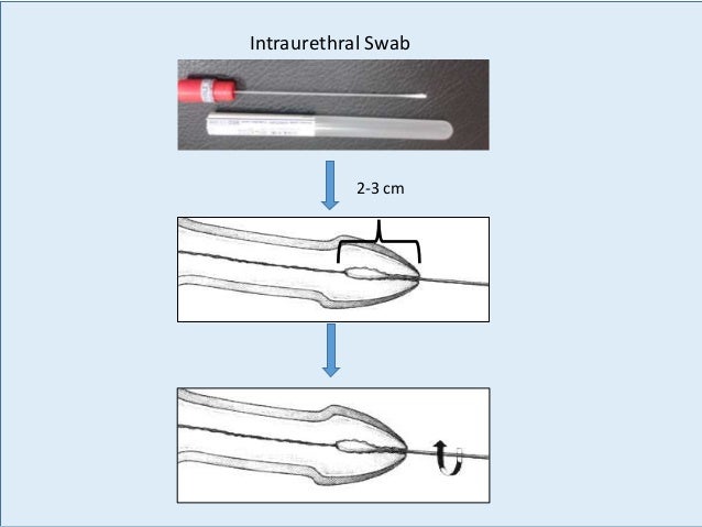 Approach to urethral discharge