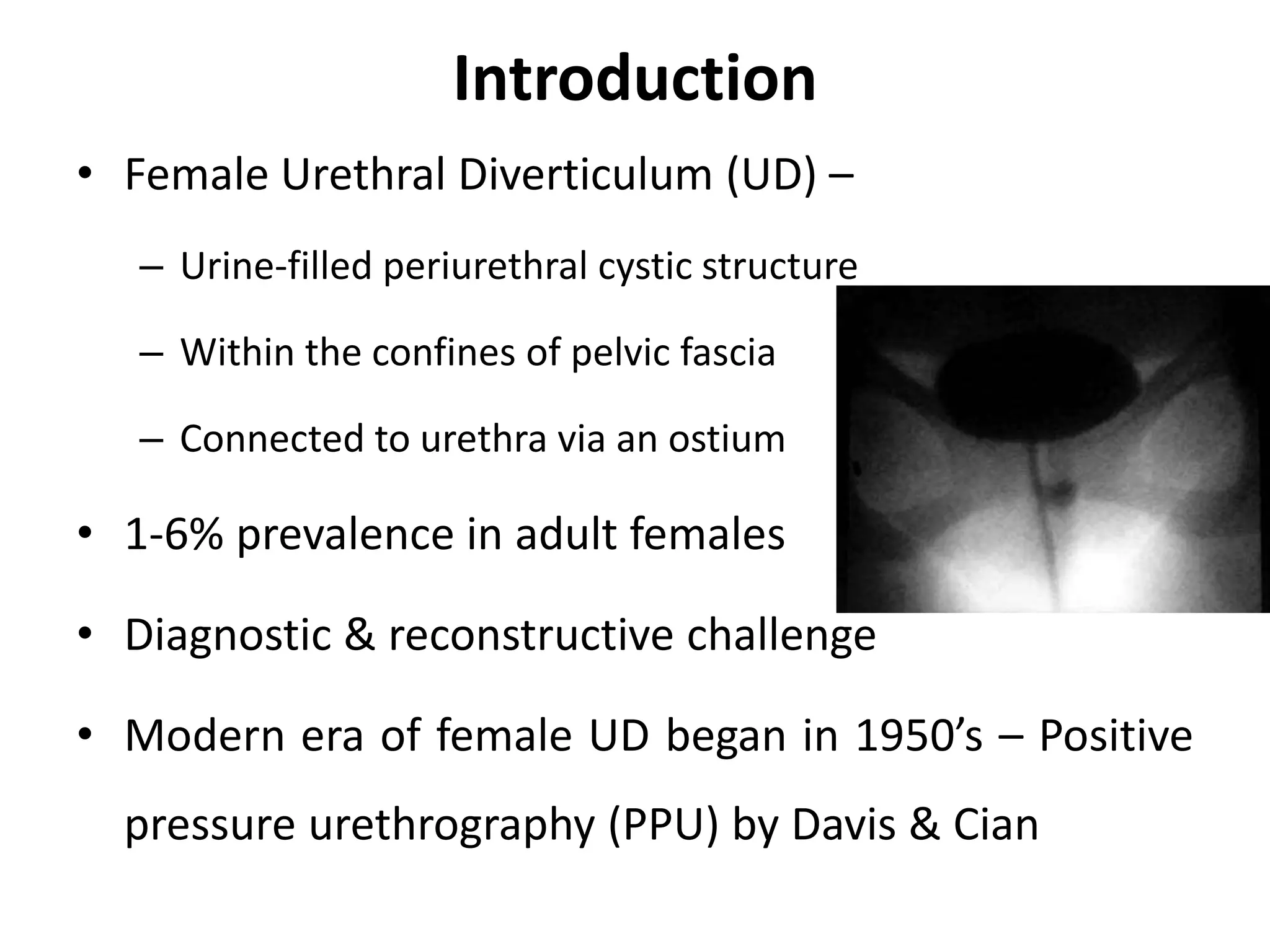 Urethral diverticulum | PPTX