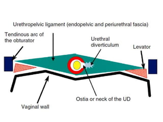 Urethral diverticulum | PPTX