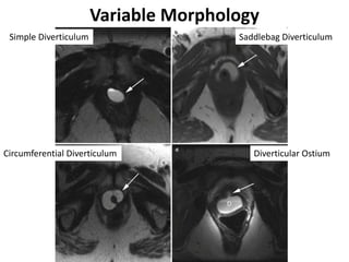 Urethral diverticulum | PPTX