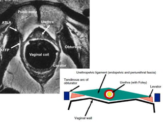 Urethral diverticulum | PPTX