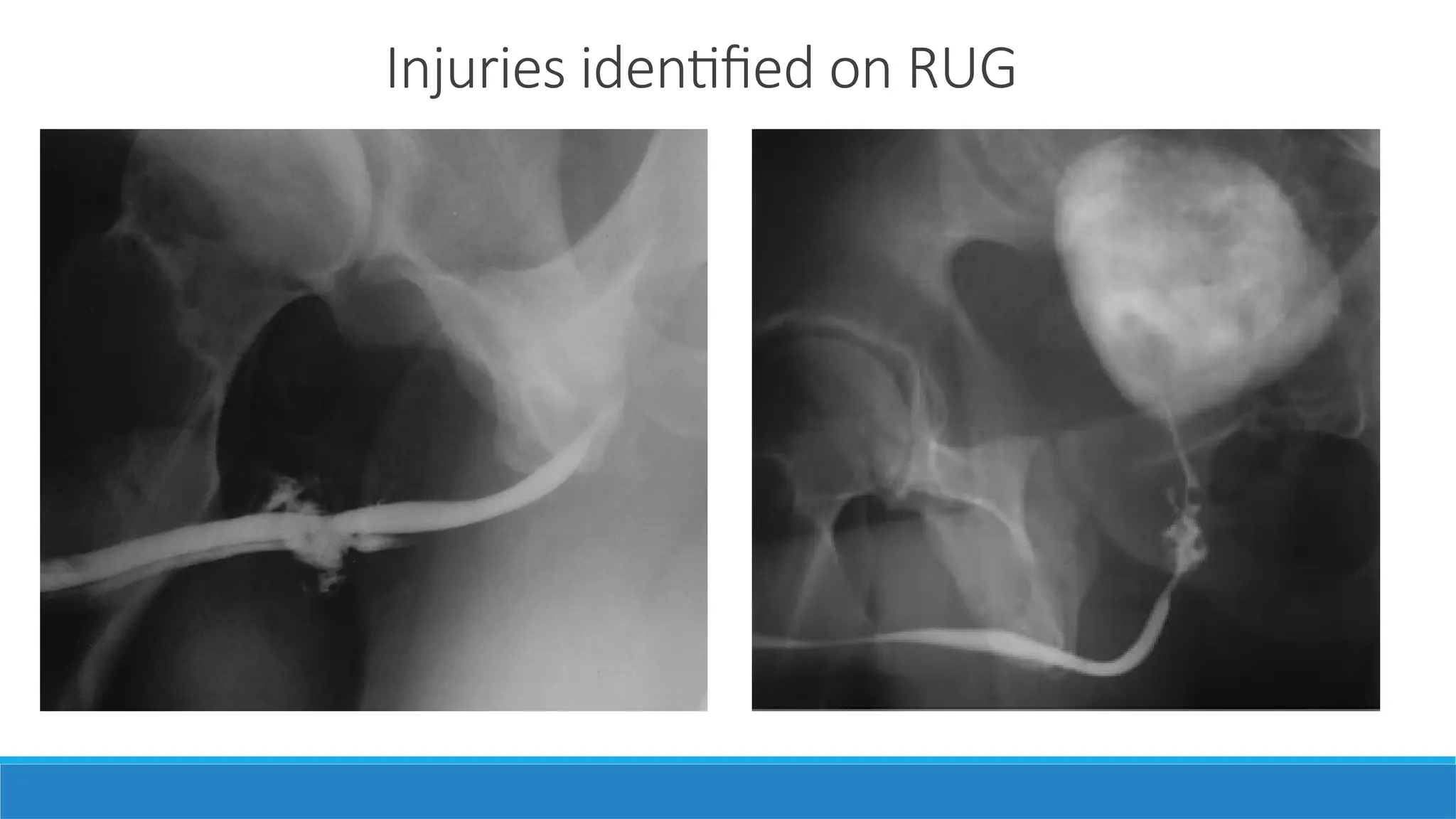 Urethral Injuries Introduction diagnosis | PPTX