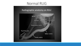 Urethral Injuries Introduction diagnosis | PPTX
