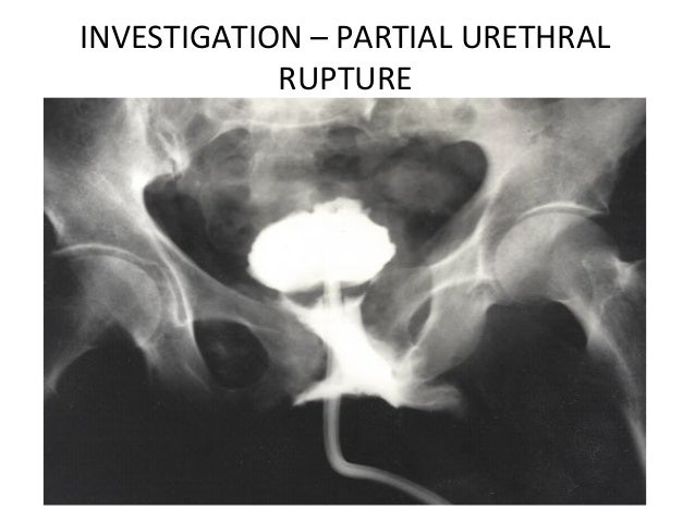 Urethral injury
