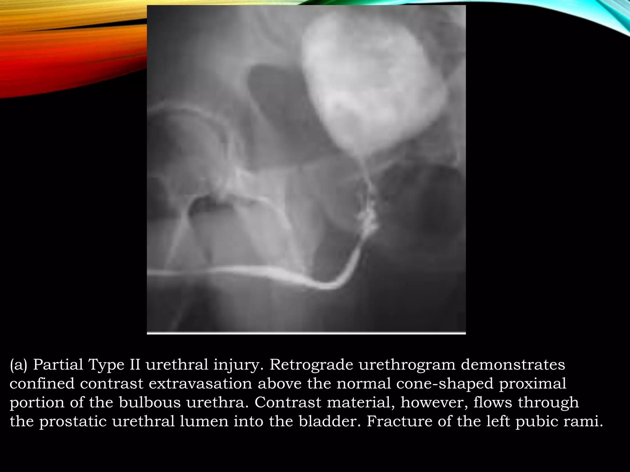 IMAGING OF URETHRAL INJURY | PPTX
