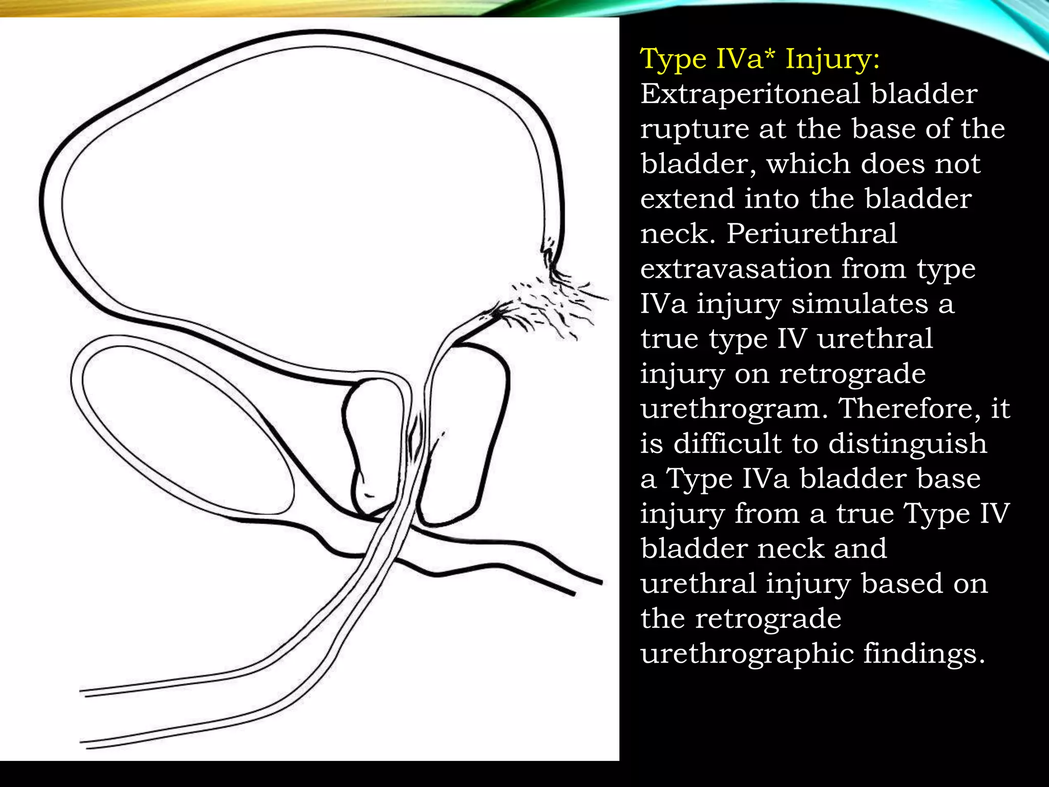IMAGING OF URETHRAL INJURY | PPTX