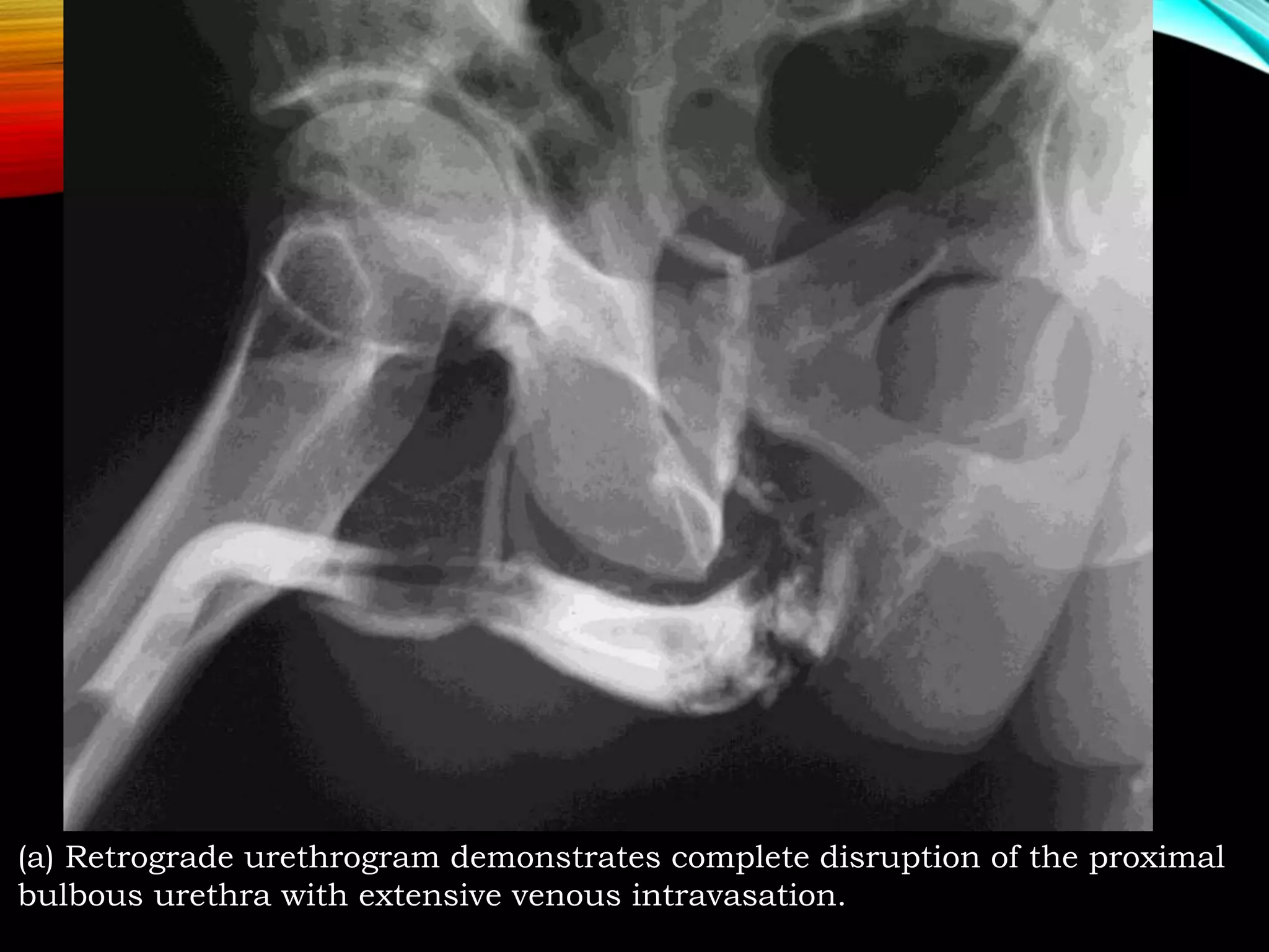 IMAGING OF URETHRAL INJURY | PPTX