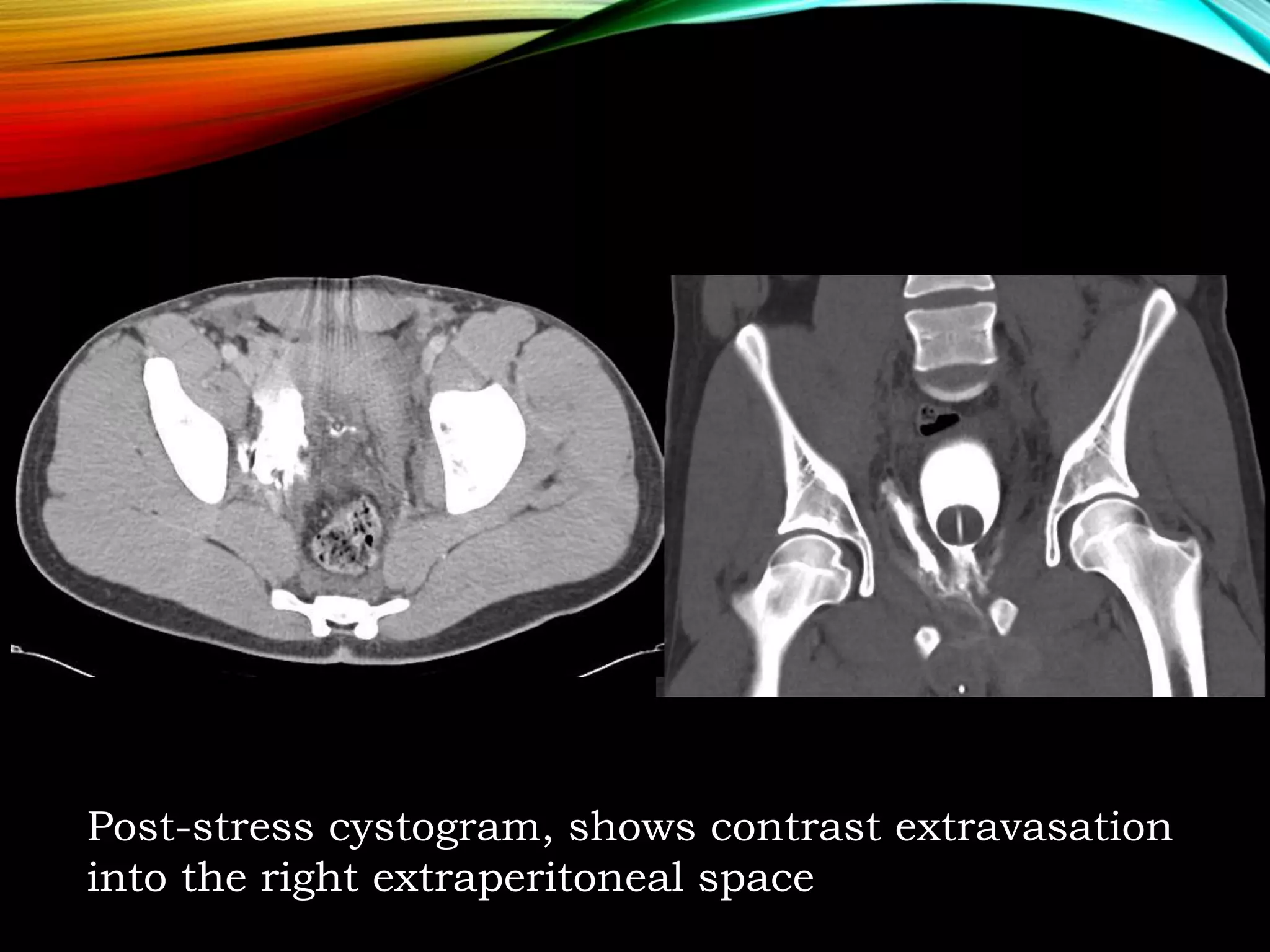 IMAGING OF URETHRAL INJURY | PPTX