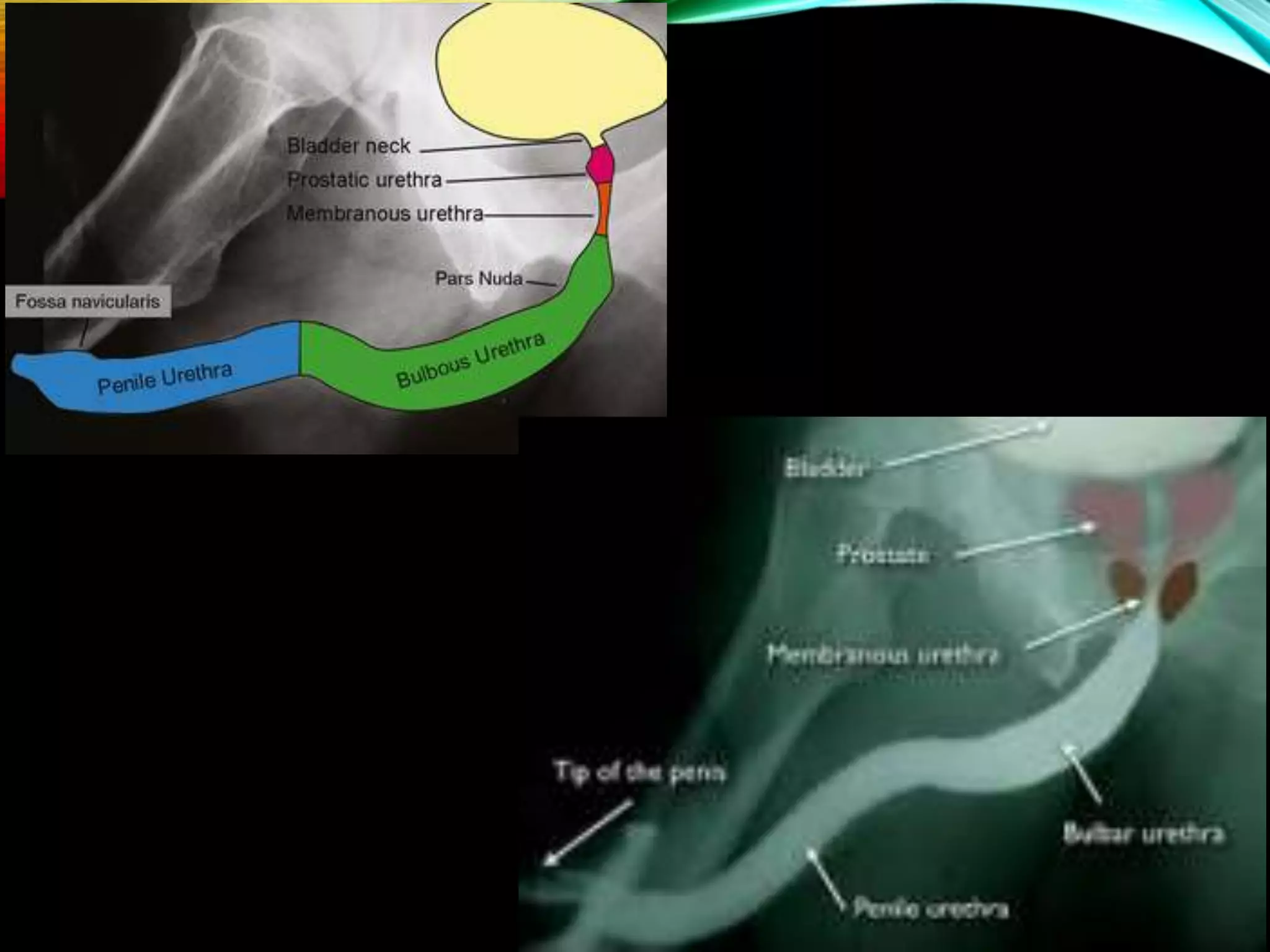 IMAGING OF URETHRAL INJURY | PPTX