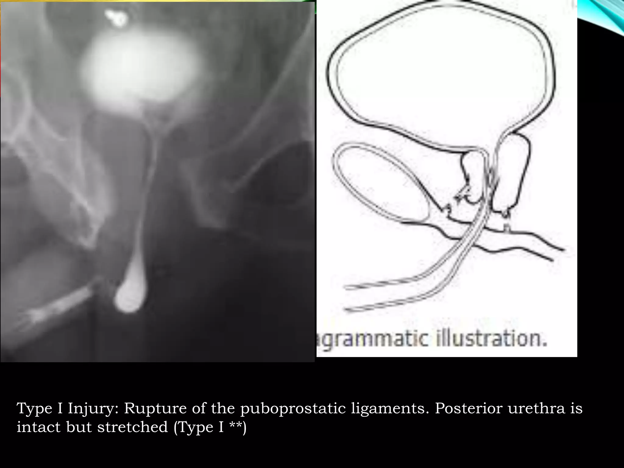 IMAGING OF URETHRAL INJURY | PPTX
