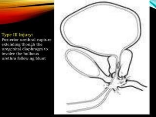 IMAGING OF URETHRAL INJURY | PPTX