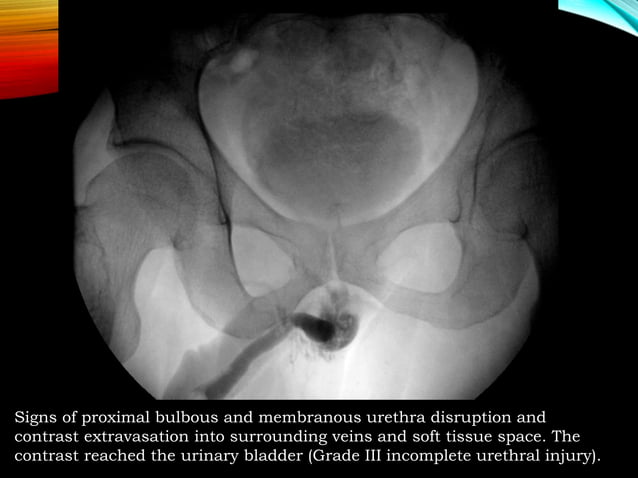 IMAGING OF URETHRAL INJURY | PPTX | Sexual Conditions | Sexual Health