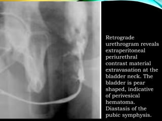 IMAGING OF URETHRAL INJURY | PPTX