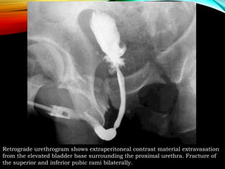IMAGING OF URETHRAL INJURY | PPTX