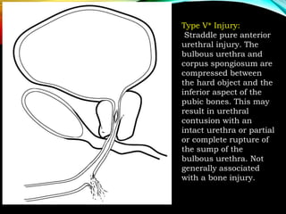 IMAGING OF URETHRAL INJURY | PPTX