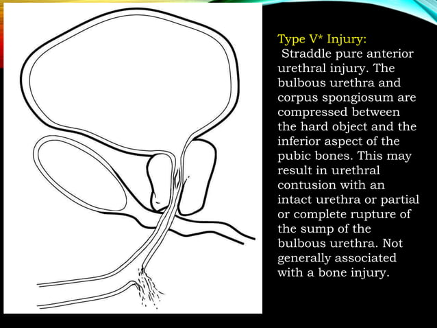IMAGING OF URETHRAL INJURY | PPTX | Sexual Conditions | Sexual Health