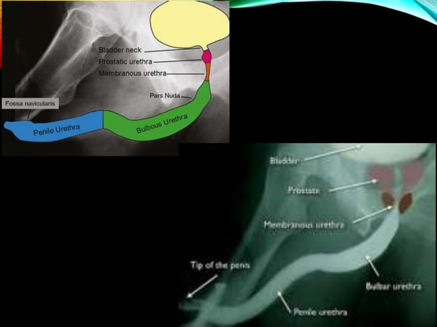 IMAGING OF URETHRAL INJURY | PPTX | Sexual Conditions | Sexual Health