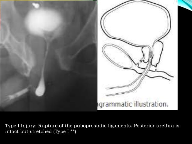 IMAGING OF URETHRAL INJURY | PPTX | Sexual Conditions | Sexual Health