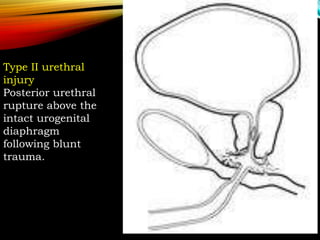 IMAGING OF URETHRAL INJURY | PPTX