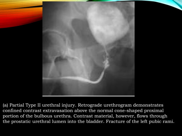 IMAGING OF URETHRAL INJURY | PPT