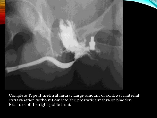 IMAGING OF URETHRAL INJURY