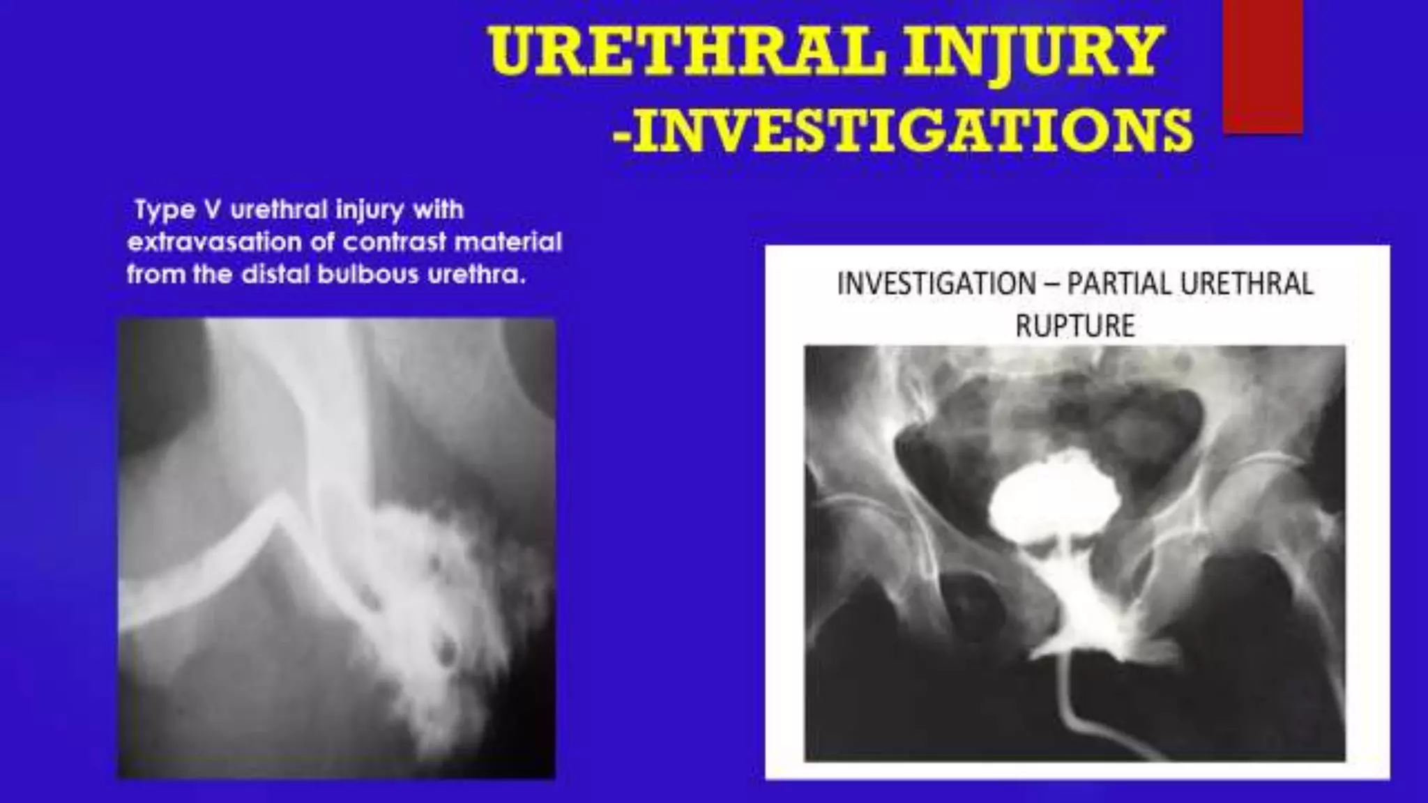 URETHRAL INJURY- Trauma Surgery | PPTX